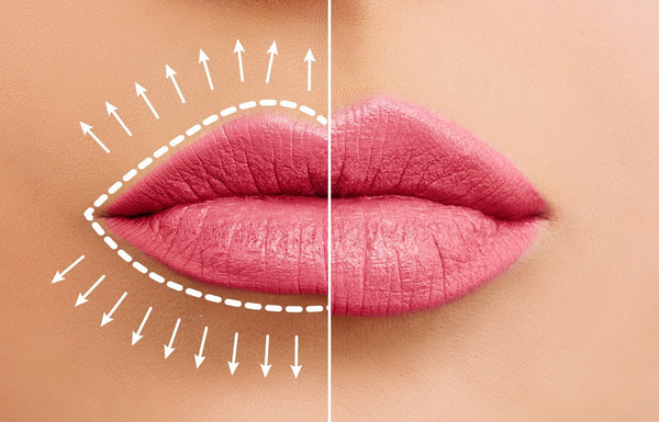 Lip Flip vs. Lip Filler: Which One Is Right for You? – Wise Aesthetics