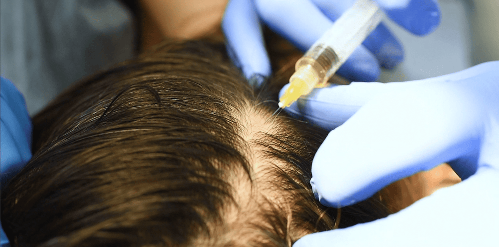 PRP Hair Growth Treatment - Plasma Restoration for Thinning Hair – Wise ...